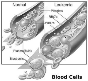 Signs and Symptoms of Childhood Leukemia - ACCO