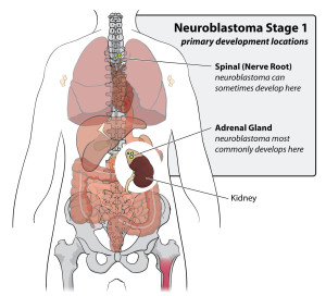 Childhood Neuroblastoma Cancer: Causes, Risk Factors, and Prevention - ACCO